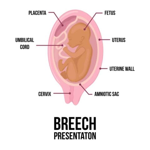 Using the Webster Chiropractic Technique for Breech Position