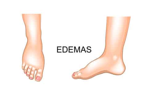 Swelling and Edema: Causes, Symptoms, and Treatments - Amazing Life ...